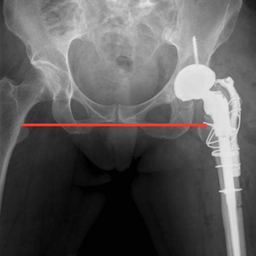 Case 17 Revision Surgery For A Dislocating Hip Replacement Using A Modular Taper Fluted Stem