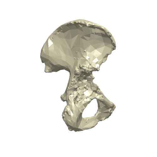 CASE 16: Proximal femoral replacement and a custom 3D-printed ...