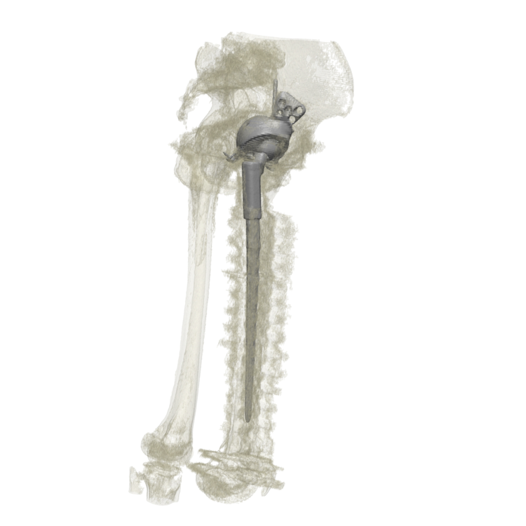 CASE 16: Proximal femoral replacement and a custom 3D-printed ...