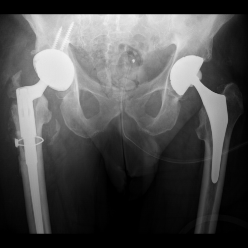 CASE 38: Revision for infection using a standard cup and 3D printed ...