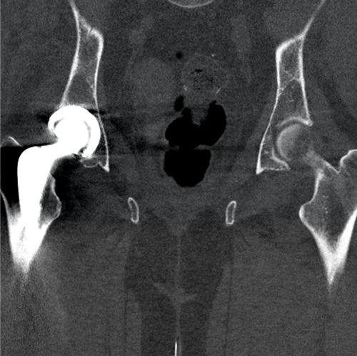 CASE 2: Robotic assisted primary hip replacement, with post-operative ...