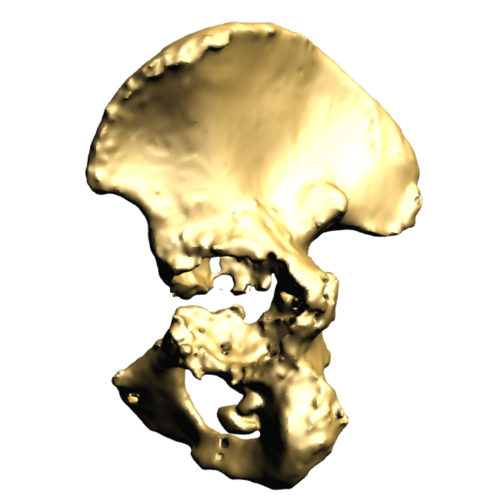 CASE 27: Revision of a loose cup due to massive superior acetabular ...