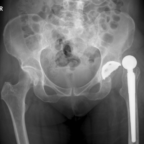 Case 17 Revision Surgery For A Dislocating Hip Replacement Using A Modular Taper Fluted Stem