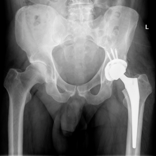 CASE 37: Revision of the femoral stem for pain and malalignment causing ...