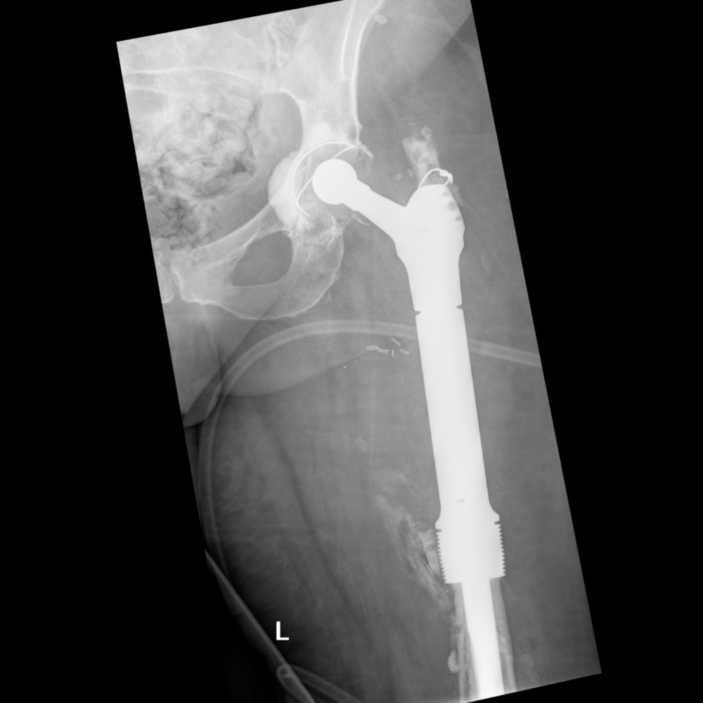 CASE 20: Proximal femoral replacement following multiple failed ...