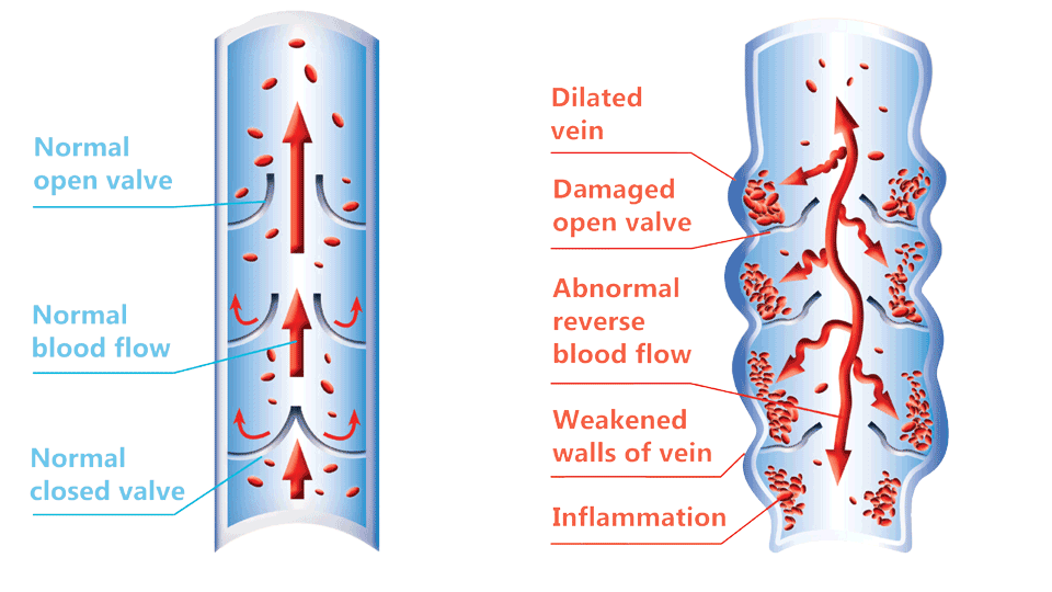 Varicose Vein, Spider Vein, Cosmetic Vein Treatment Clinic Gisborne ...