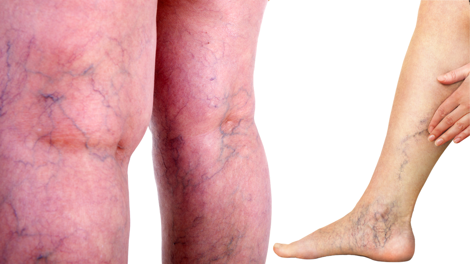 Varicose Vein, Spider Vein, Cosmetic Vein Treatment Clinic Gisborne ...