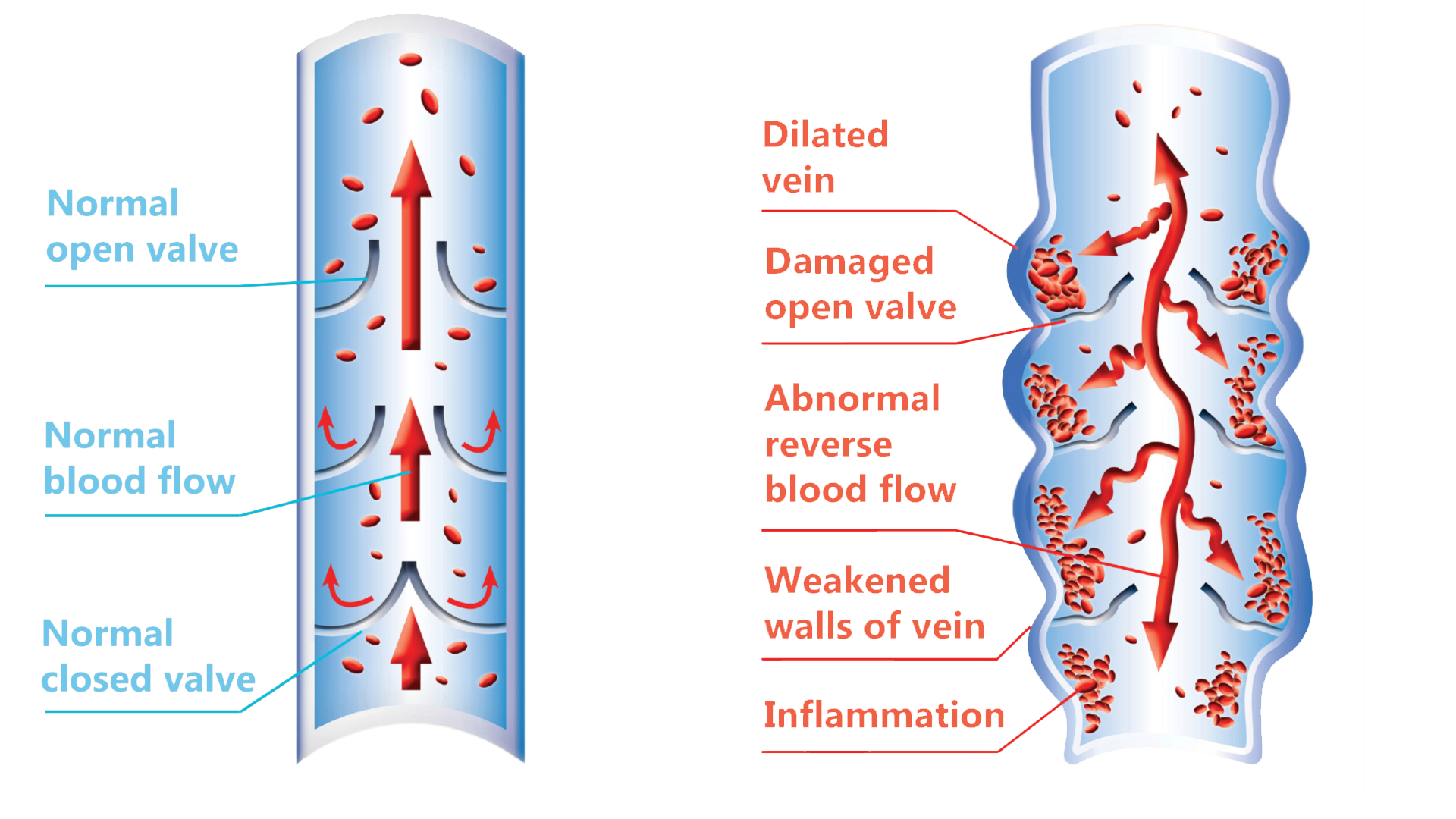 Varicose Vein, Spider Vein, Cosmetic Vein Treatment Clinic Gisborne ...