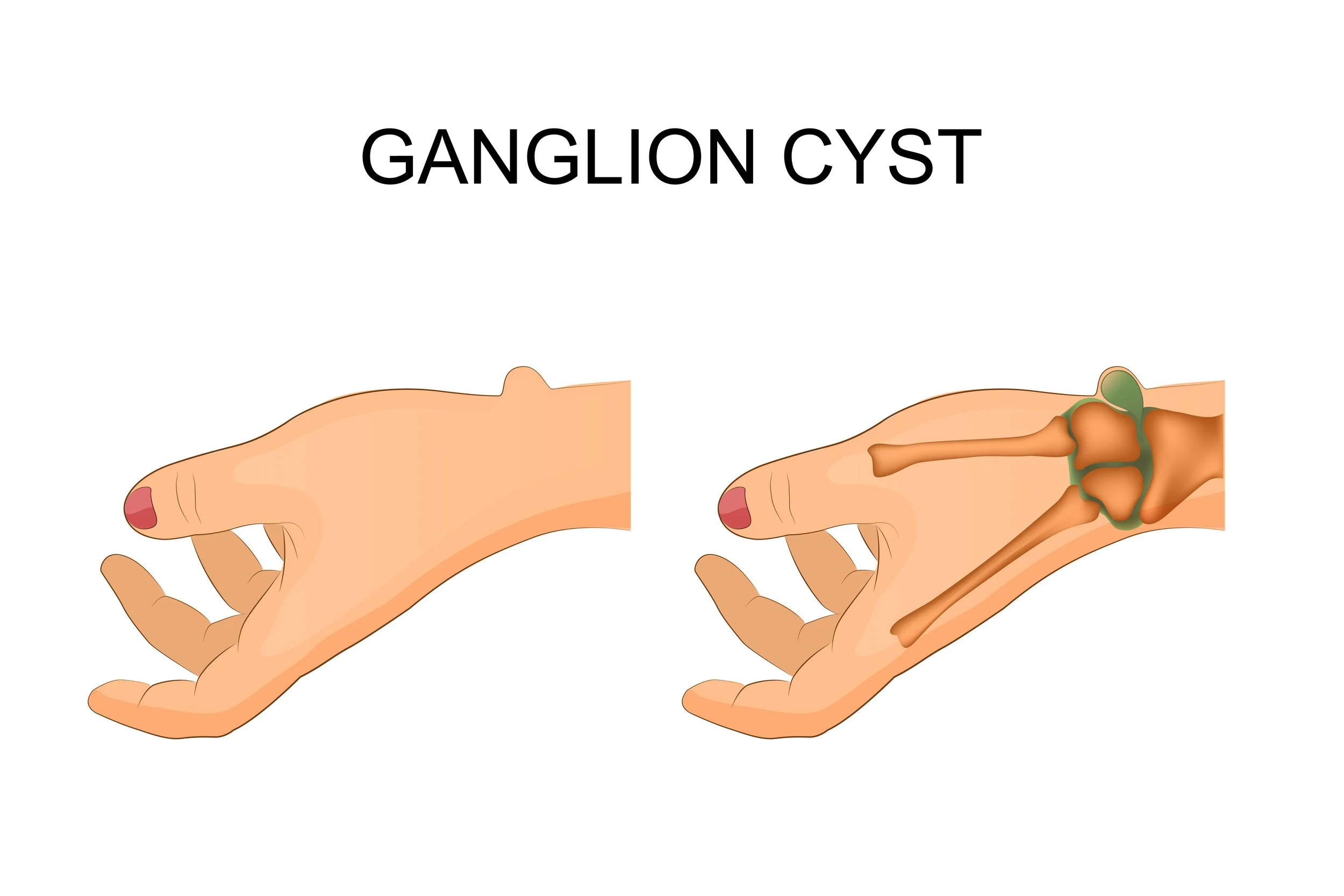 Ganglion Cyst Surgery