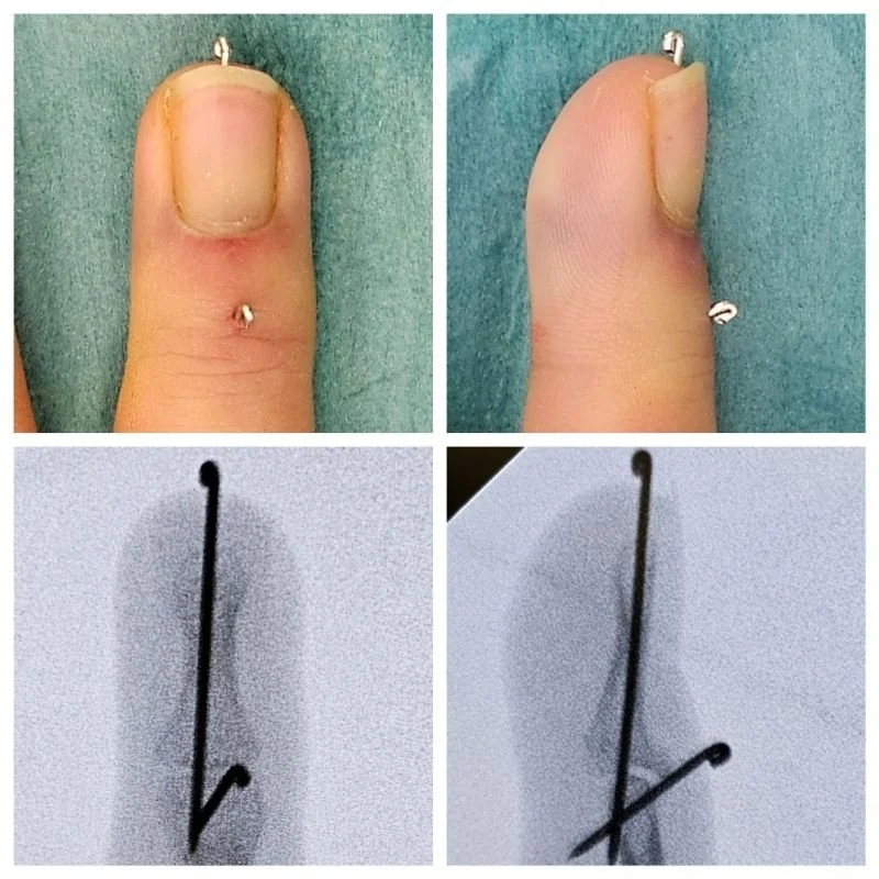 Mallet Finger: Understanding the Condition, Treatment Options, and the ...