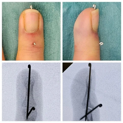 Mallet Finger: Understanding the Condition, Treatment Options, and the ...