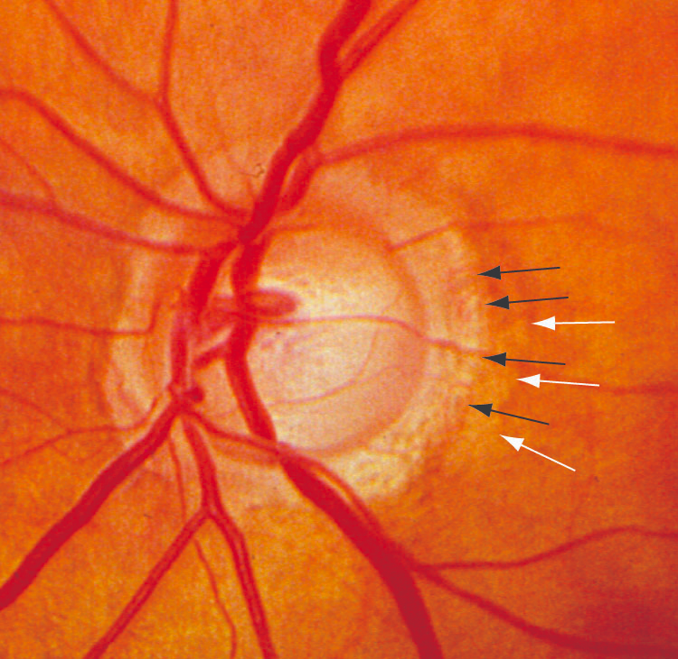 Connie M. Wu, MD - Optic disc