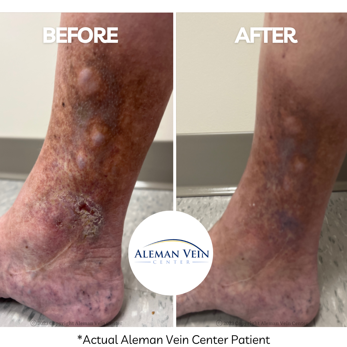 Leg Ulcer Leg Ulcer