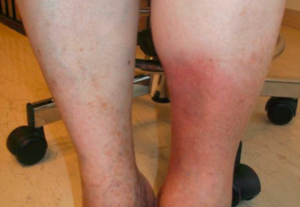 Aleman Vein Center is an Atlanta vein clinic that offers the best ...