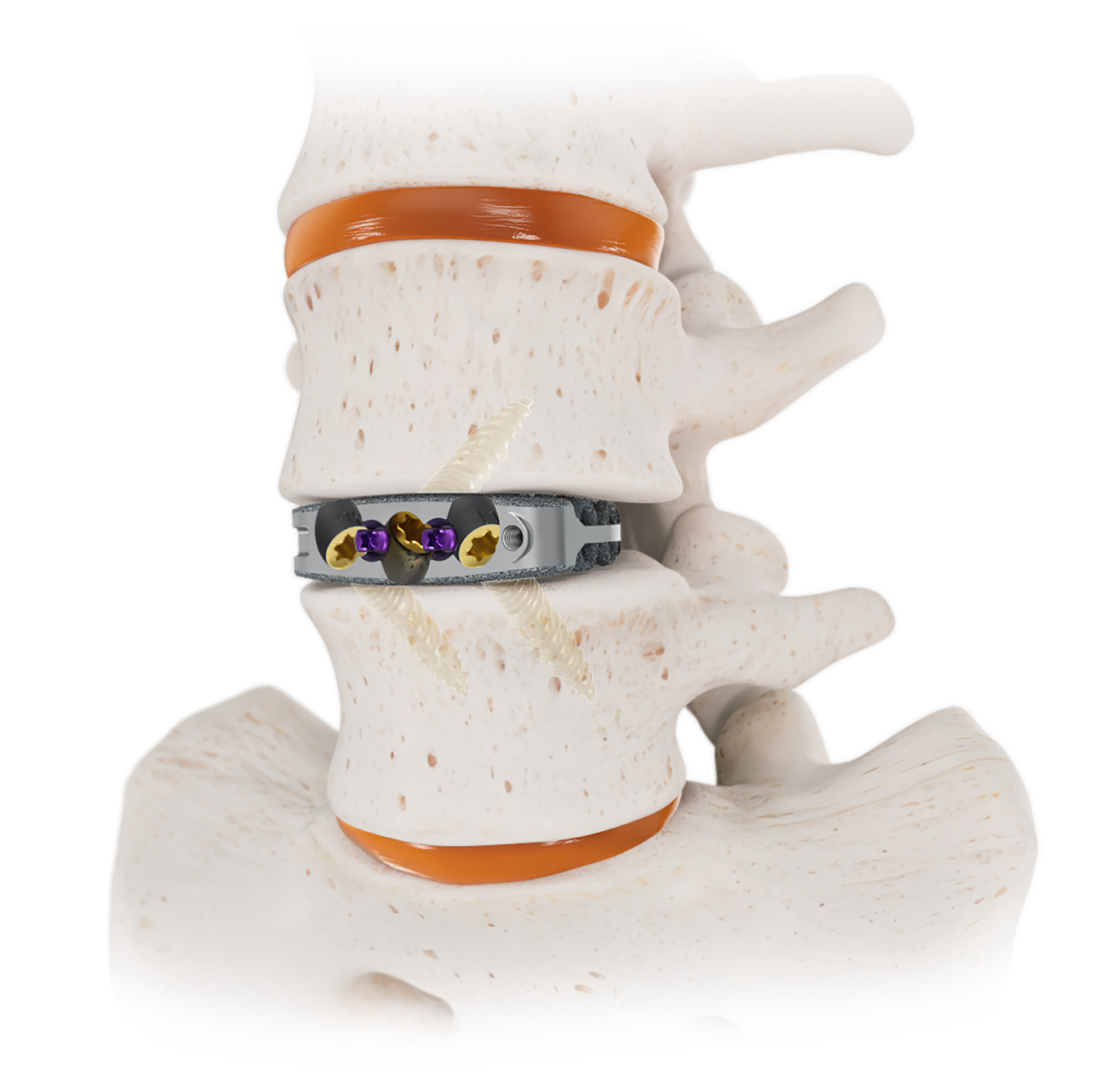 SPIRA-A — Camber Spine Med Tech