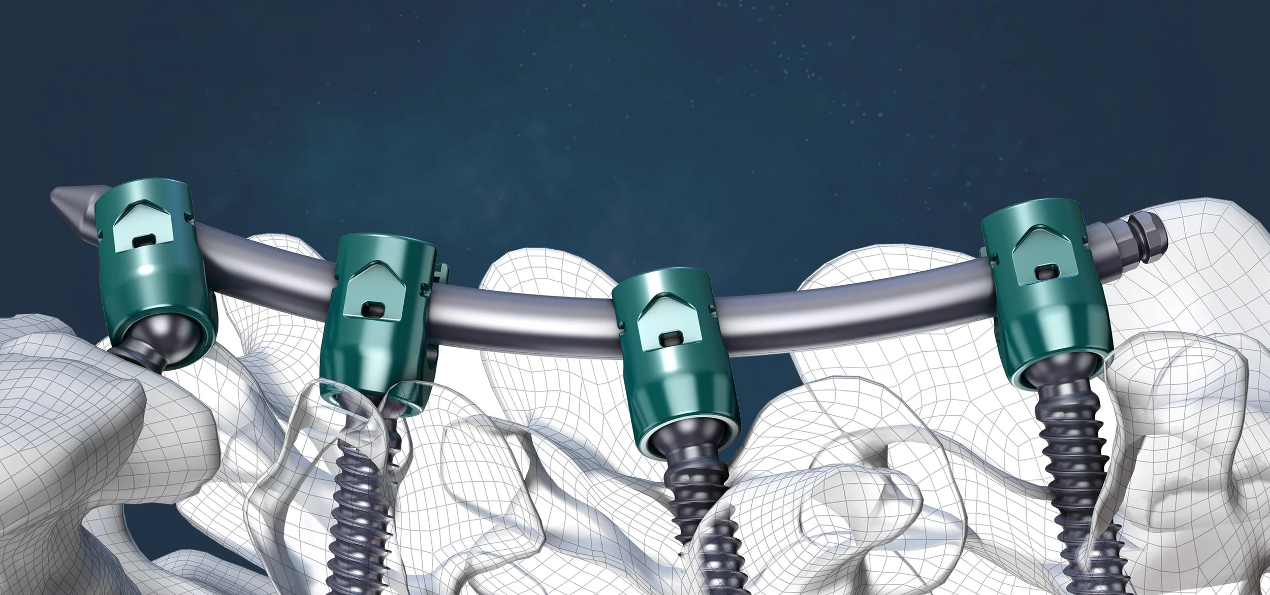 Orthros MIS Screw Fixation — Camber Spine Med Tech