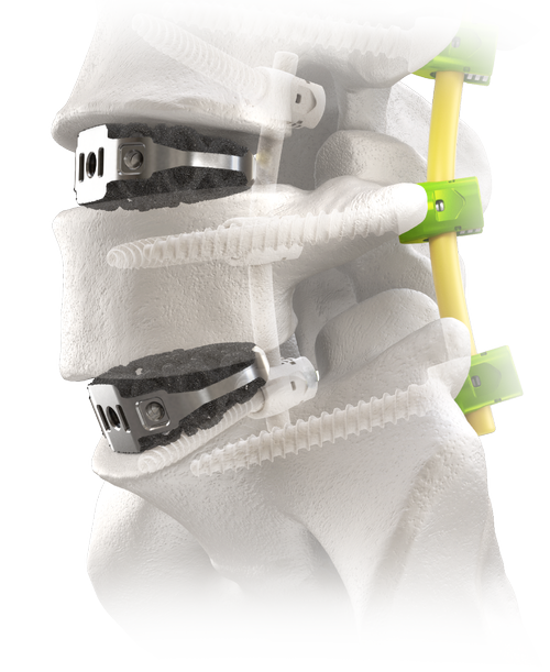 SPIRA-A — Camber Spine Med Tech