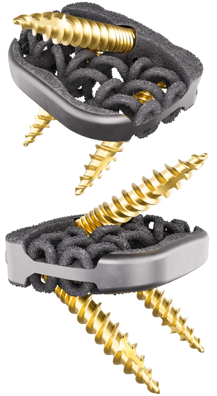 SPIRA-A — Camber Spine Med Tech