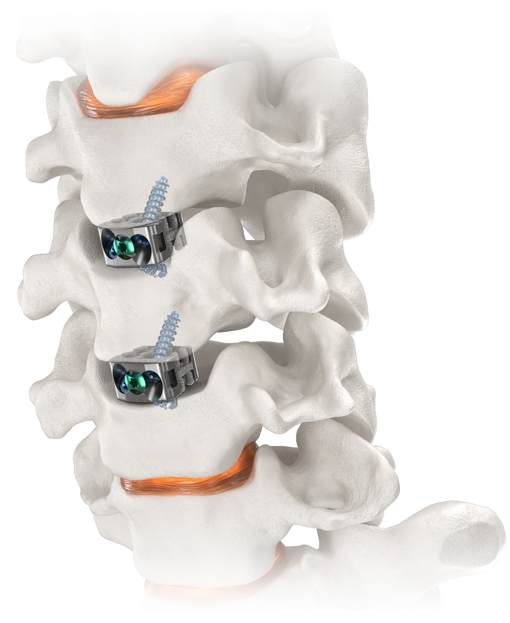 SPIRA-C Integrated — Camber Spine Med Tech