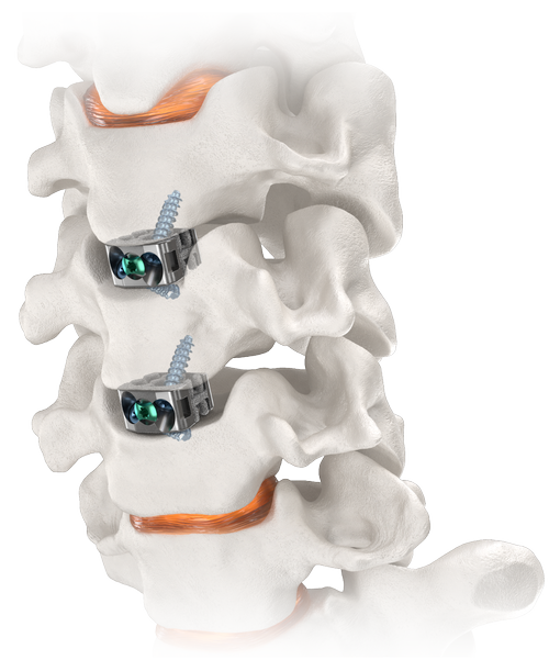 SPIRA-C Integrated — Camber Spine Med Tech