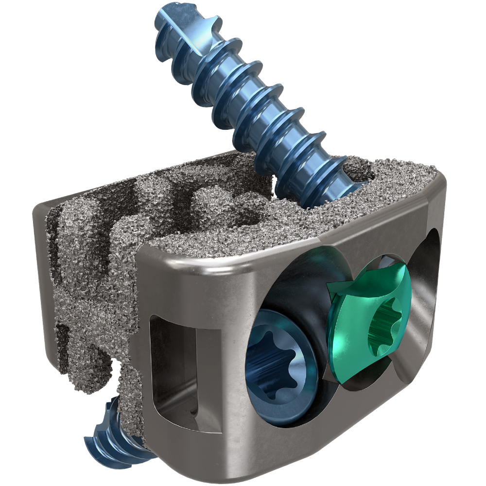 SPIRA-C Integrated — Camber Spine Med Tech