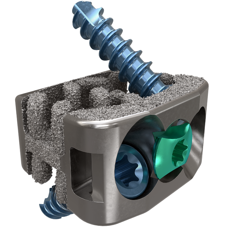 SPIRA-C Integrated — Camber Spine Med Tech