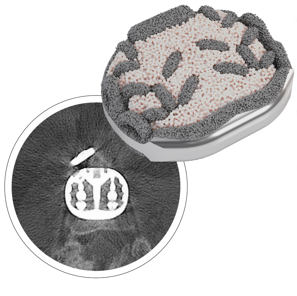 SPIRA Technology — Camber Spine Med Tech