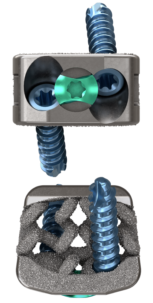 SPIRA-C Integrated — Camber Spine Med Tech