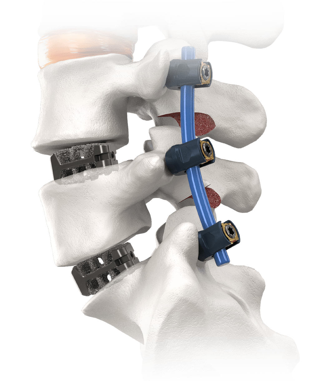 SPIRA-T — Camber Spine Med Tech