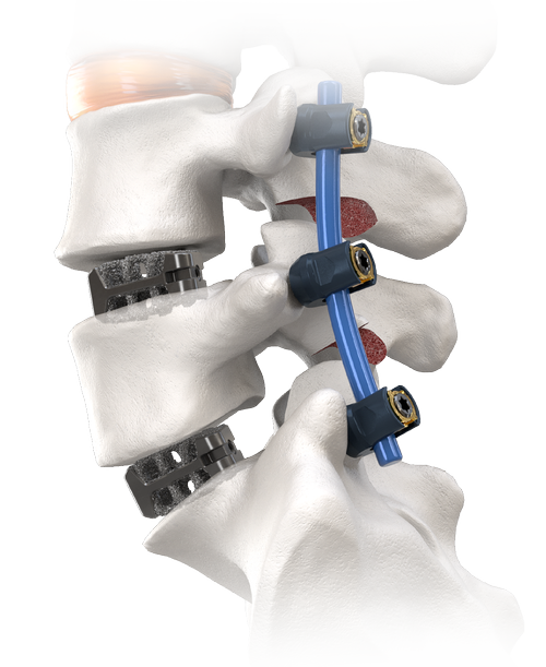 SPIRA-T — Camber Spine Med Tech