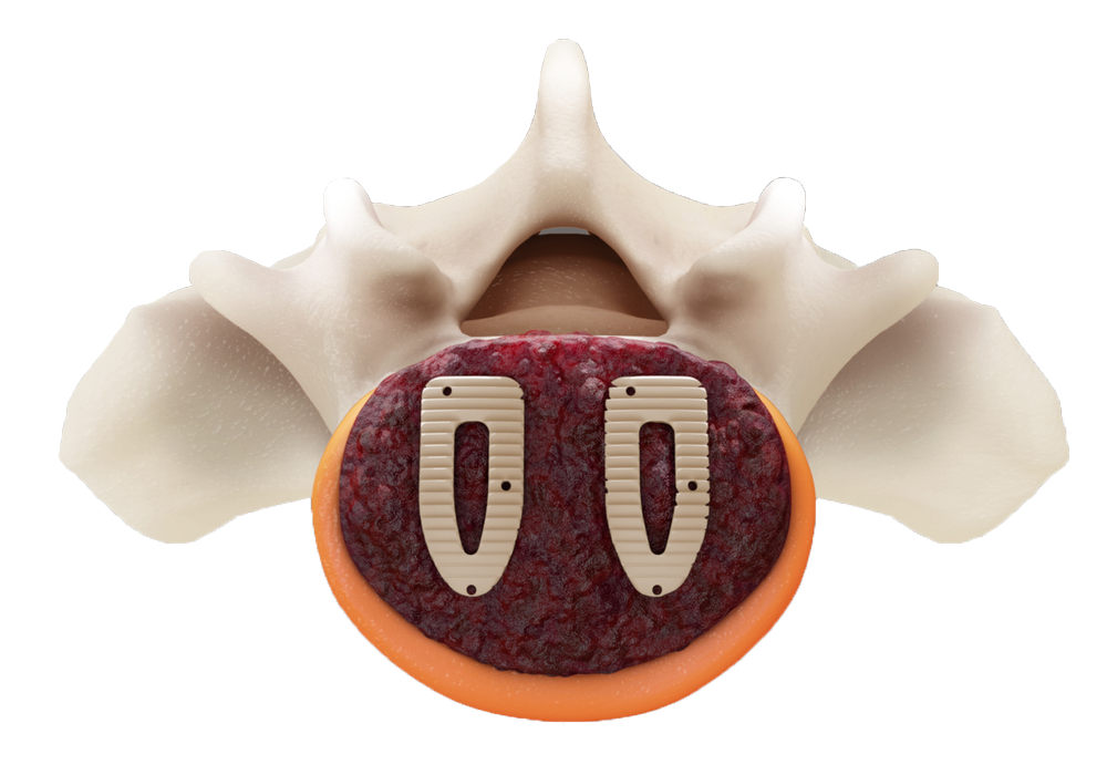 TLS 5.0 — Camber Spine Med Tech