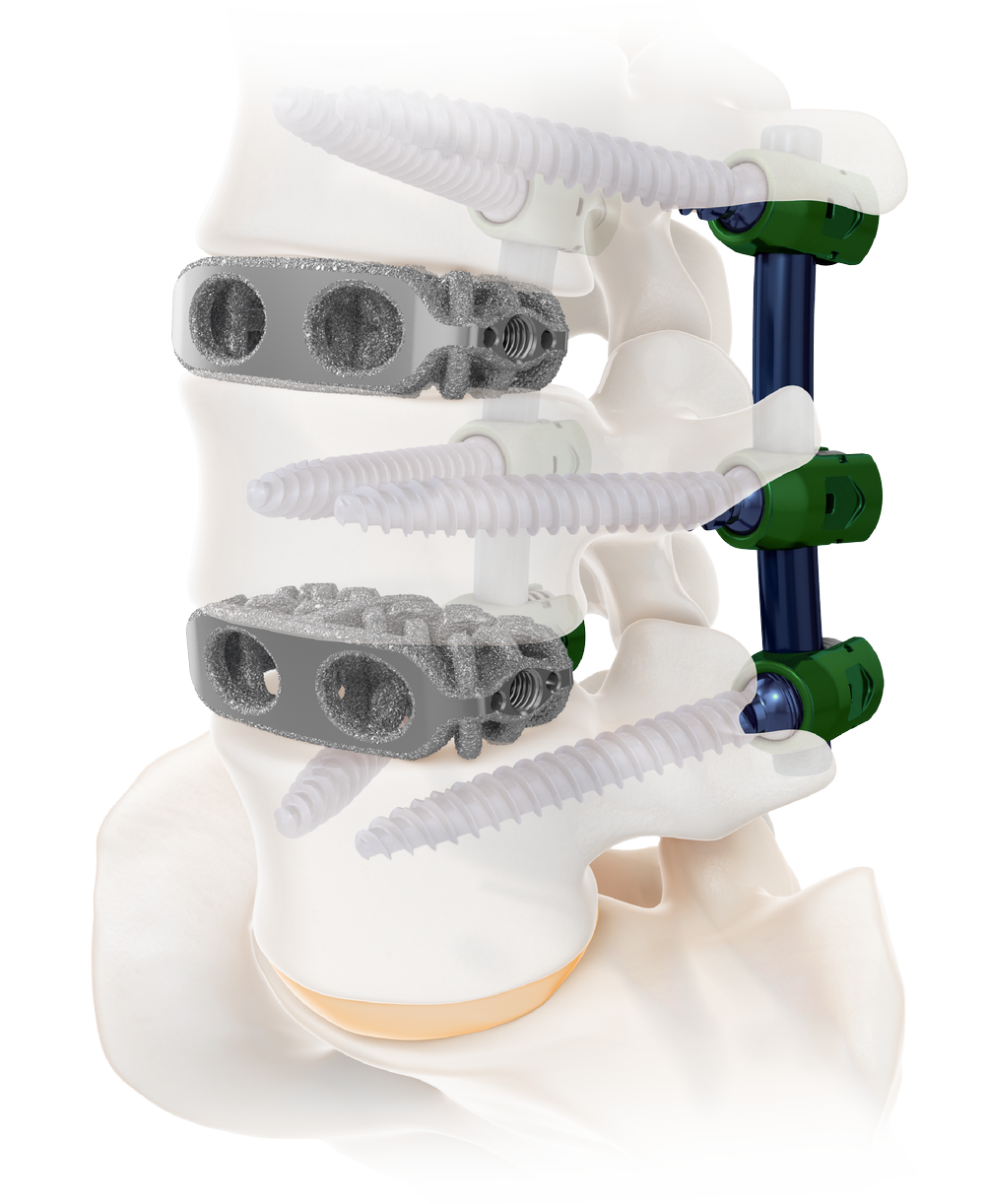 SPIRA-L — Camber Spine Med Tech