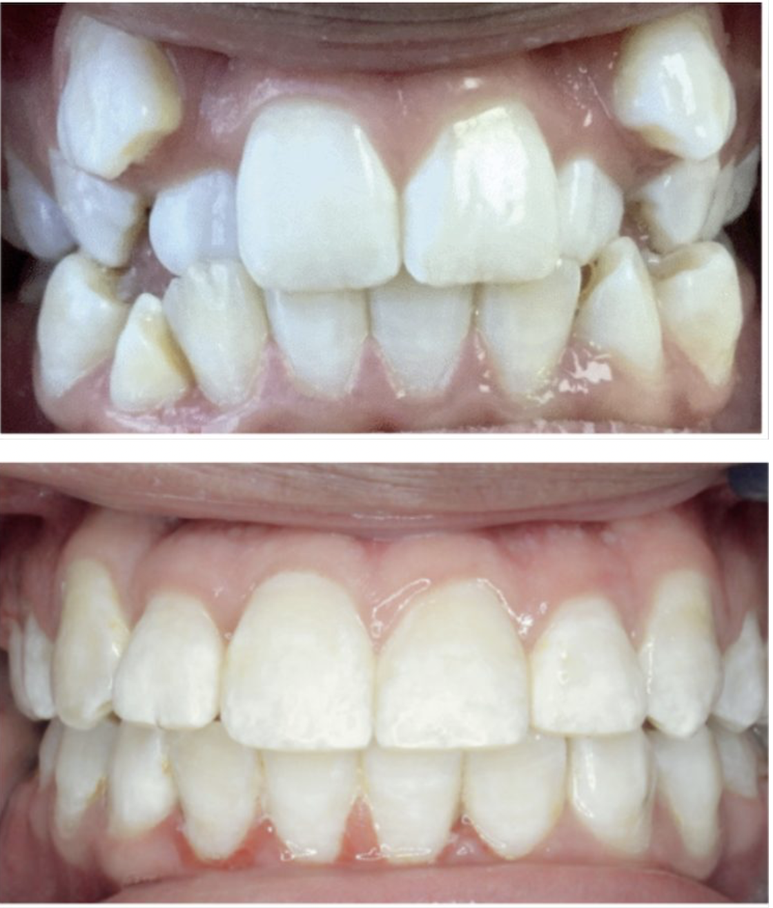 Our Services: My Forever Smile® — Shattuck Dentistry & Braces