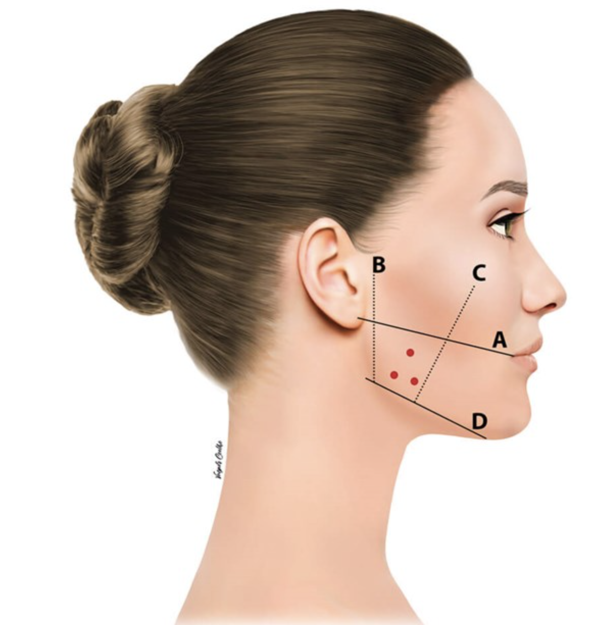 Botox for Masseters: Relieve TMJ & Slim Your Face at Core Aesthetic ...