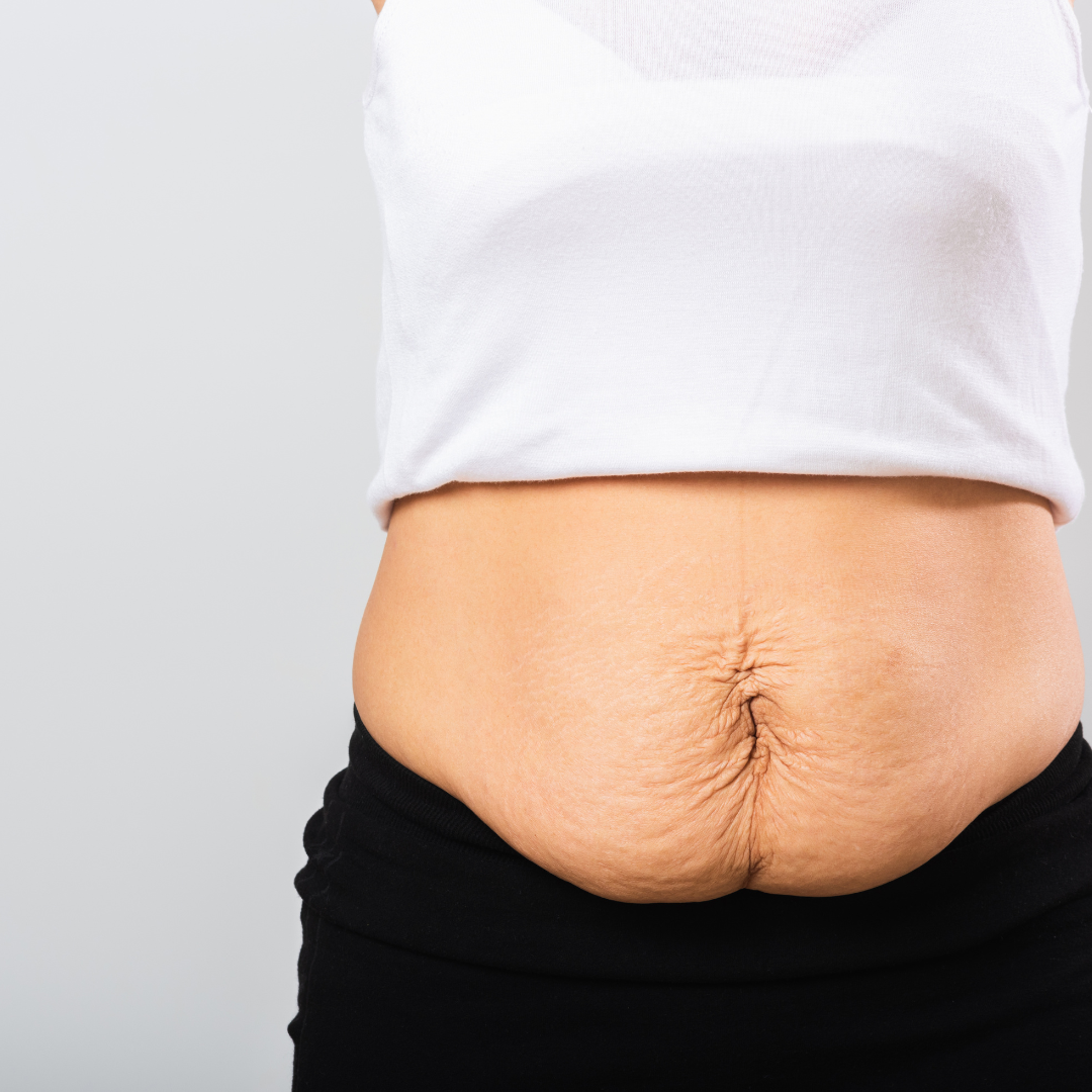 Inmode Tone on EvolveX — Core Aesthetic Medspa & Weight Loss Clinic