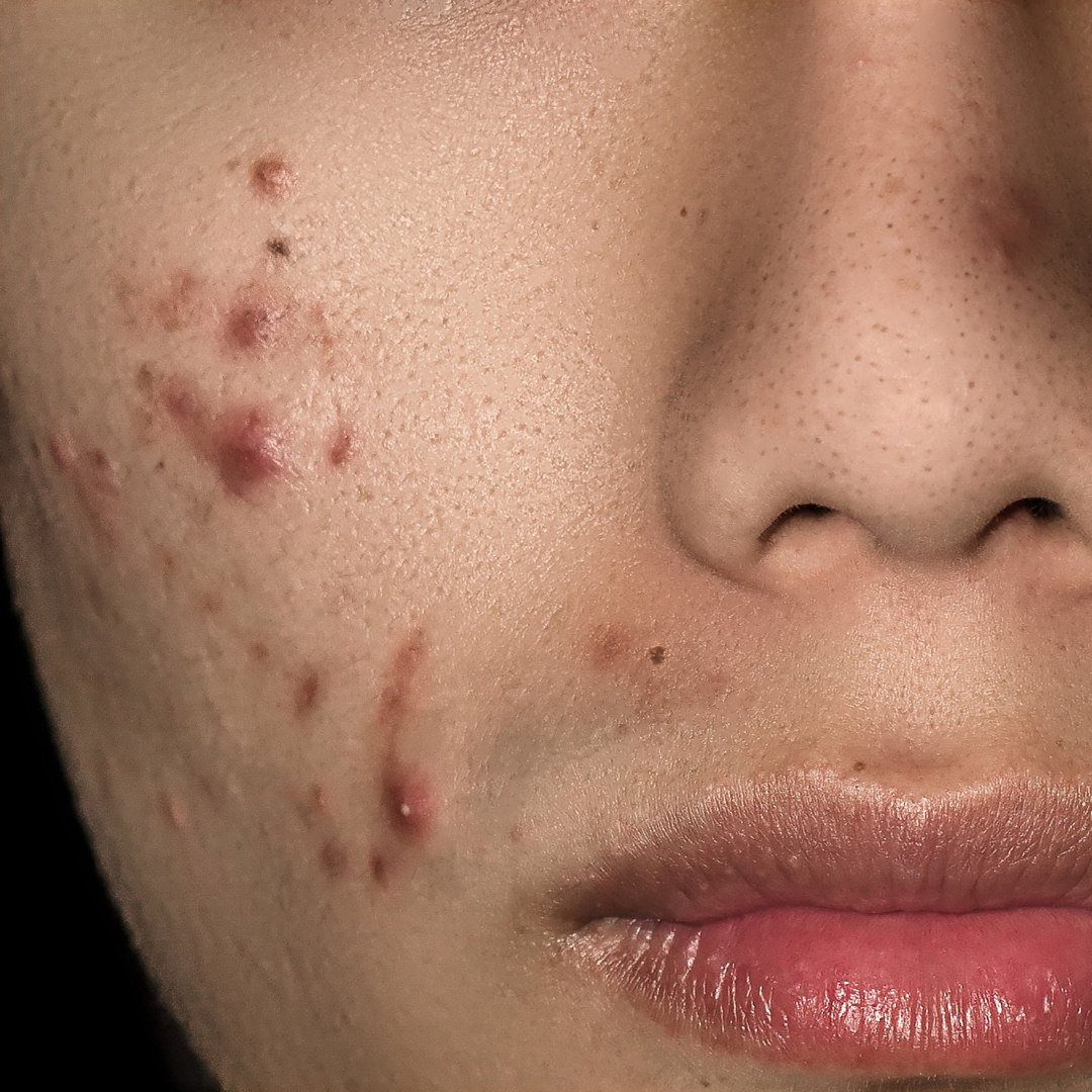 Adult Acne: Causes, Patterns, and Treatment | Core Aesthetic Falls ...