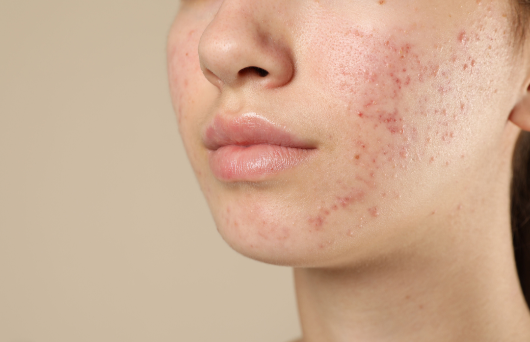 Why Your Acne Keeps Coming Back — And How to Prevent It — SKIN.RESTORED