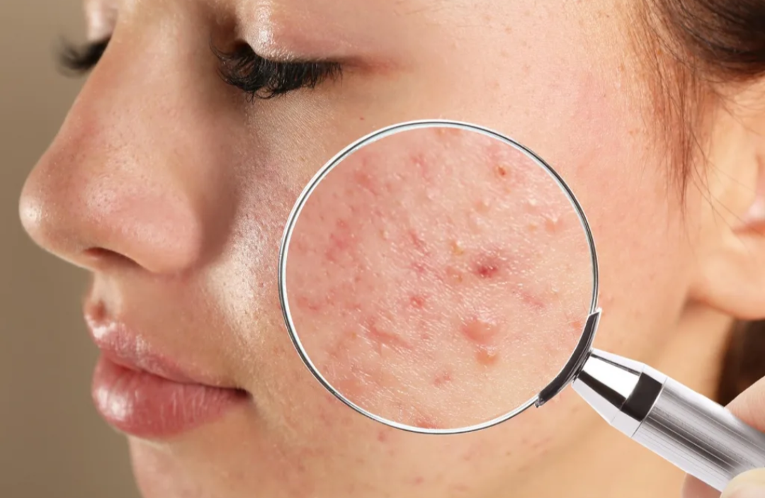 Understanding Acne Scars: Why They Form and How Professional Treatments ...