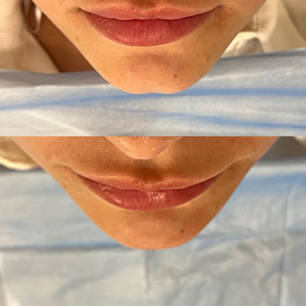Facial Dermal Fillers — Nurse Injector Michelle