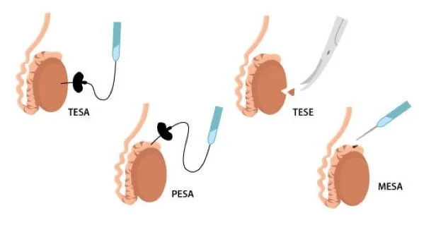 What are TESE, TESA, MicroTESE, MESA, and PESA? Sperm Extraction ...