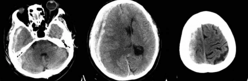 Current — Brain Trauma Foundation - Guidelines — Brain Trauma Foundation