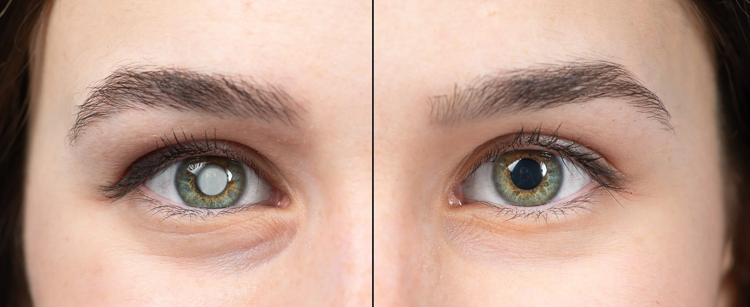 Cataract Surgery Johannesburg — Constantia Eye Clinic - Ophthalmologist