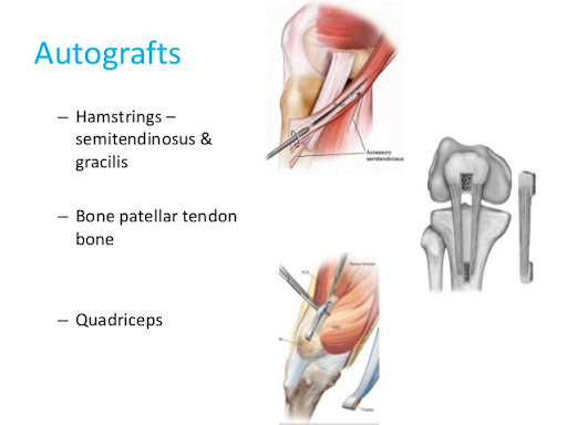 ACL Graft Options: Choosing The Graft That Works Best For You — Sarrica