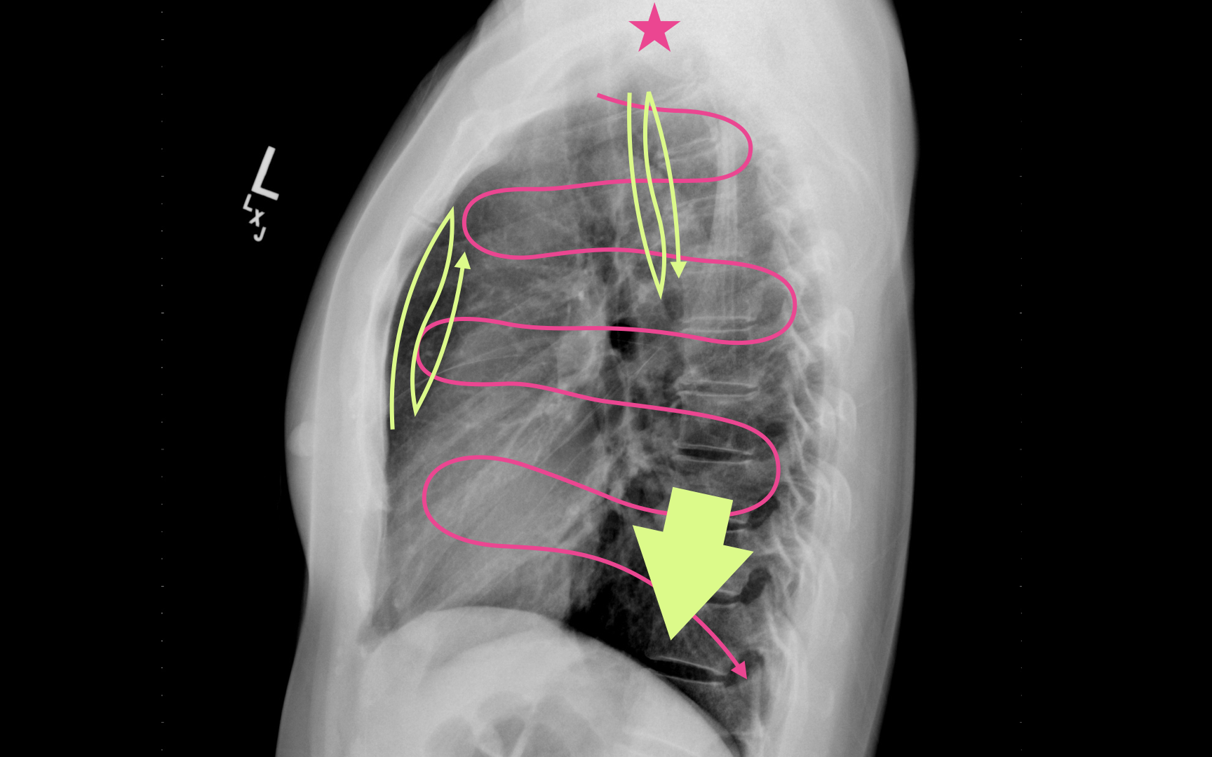 How to Read: Lateral CXR — Radiology Slides
