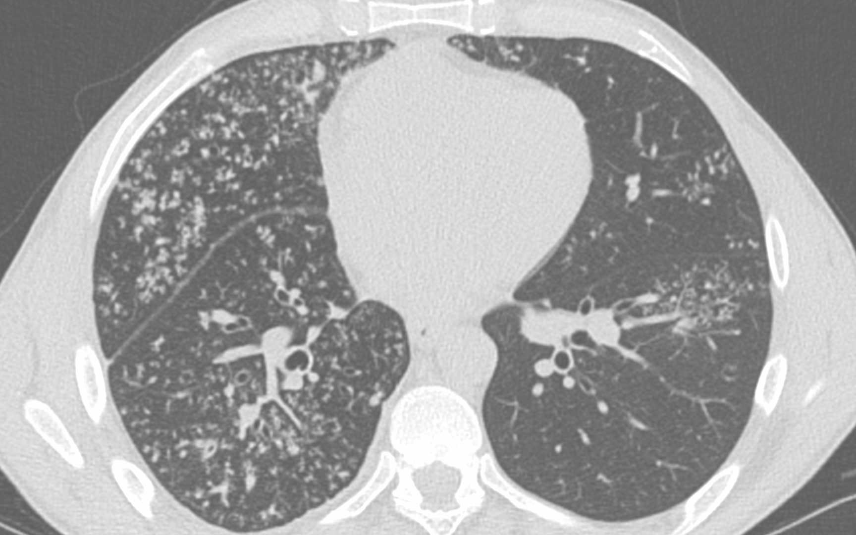 Fleischner Glossary of Terms, Part 2: Abnormal Imaging Features ...
