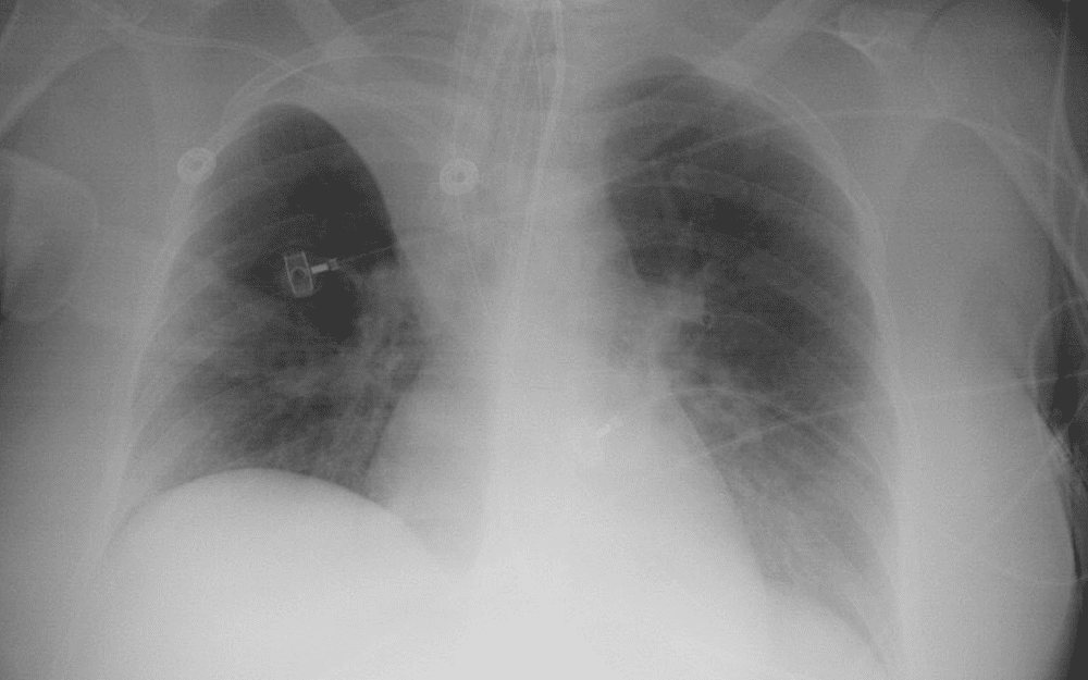 Atelectasis Chest X Ray