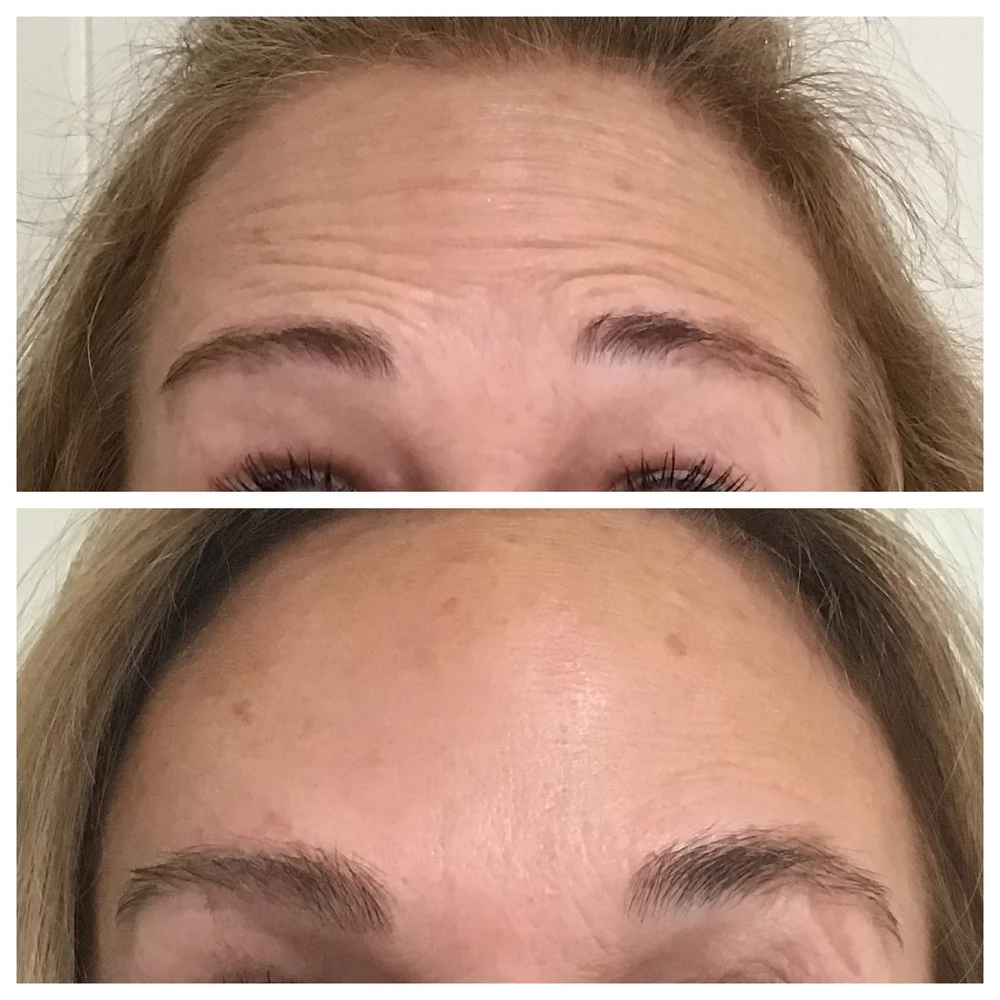 Before and After - Neuromodulators — Jaden Aesthetics