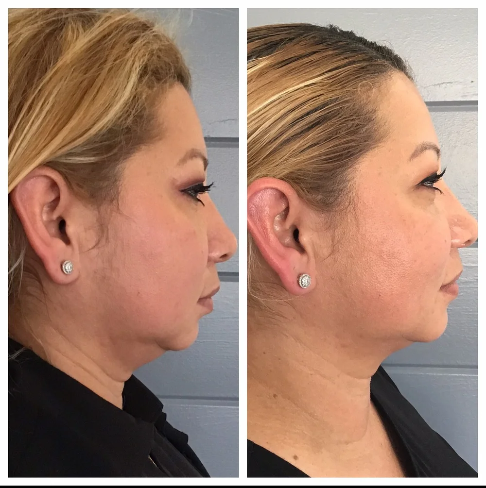 Morpheus8 — Jaden Aesthetics