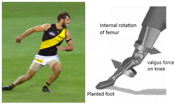 ACL Rupture: Surgery Vs Non-Surgical Management — Physio Solutions ...