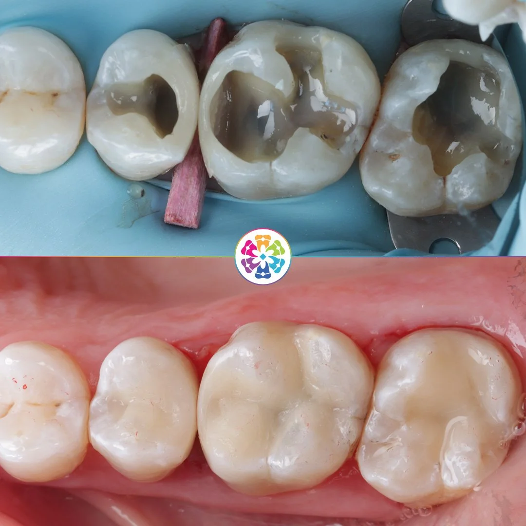 Composite Fillings — Dental Smiles Chelmsford
